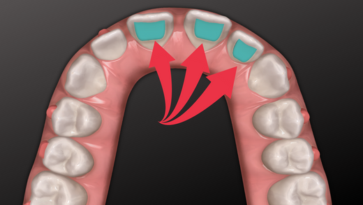 How and when to use bite ramps– The C.L.E.A.R. Institute